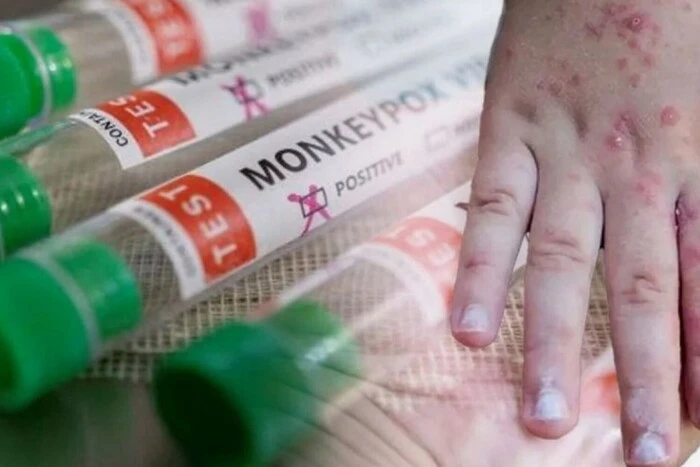 A Resilient Strain of Monkeypox Discovered in Europe: What We Know ...